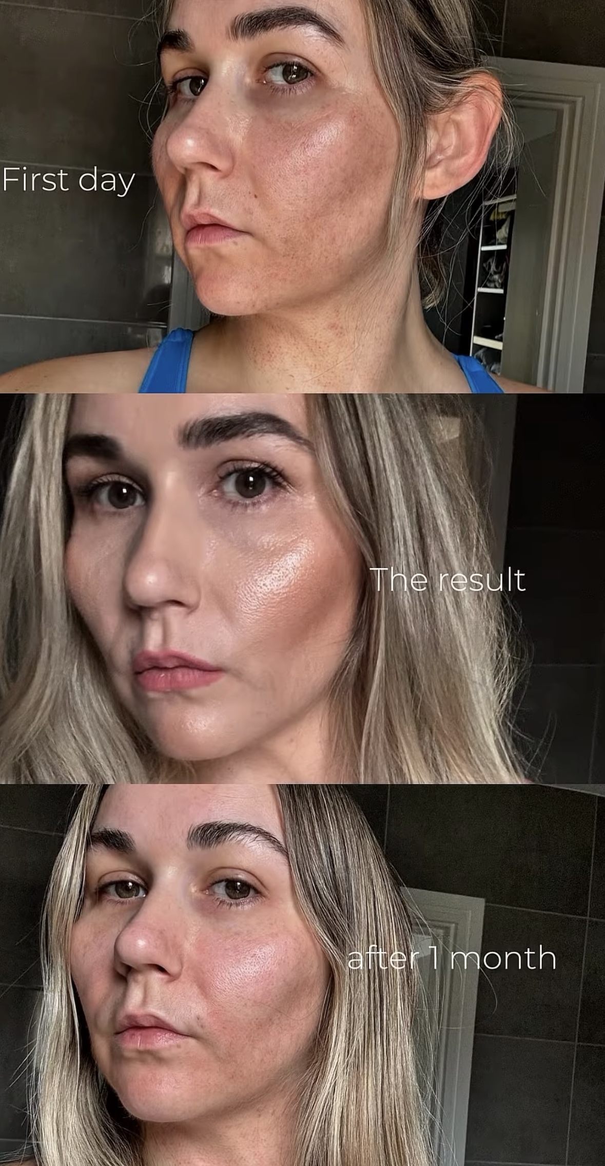 Collagen Treatments in Plymouth